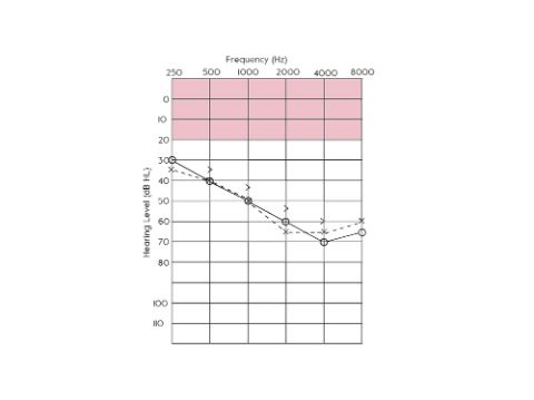 What is an Audiogram? | Hearing Services | Amplifon AU
